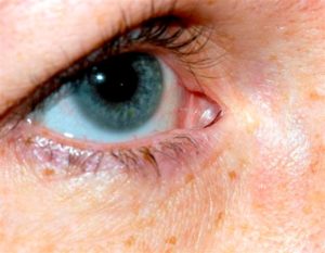 Jones Tube - Ophthalmic Consultants of Vermont