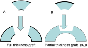 Deep Anterior Lamellar Keratoplasty (DALK) - Ophthalmic Consultants of ...