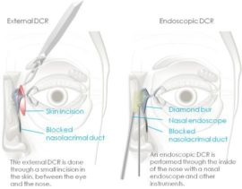 Dacryocystorhinostomy (DCR) - Ophthalmic Consultants of Vermont