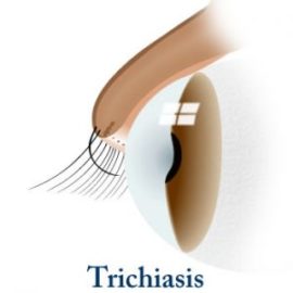 Trichiasis - Ophthalmic Consultants of Vermont